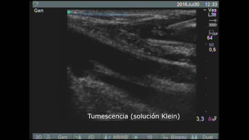 Laser endovascular. Vena Safena Accesoria Anterior insuficiente ...